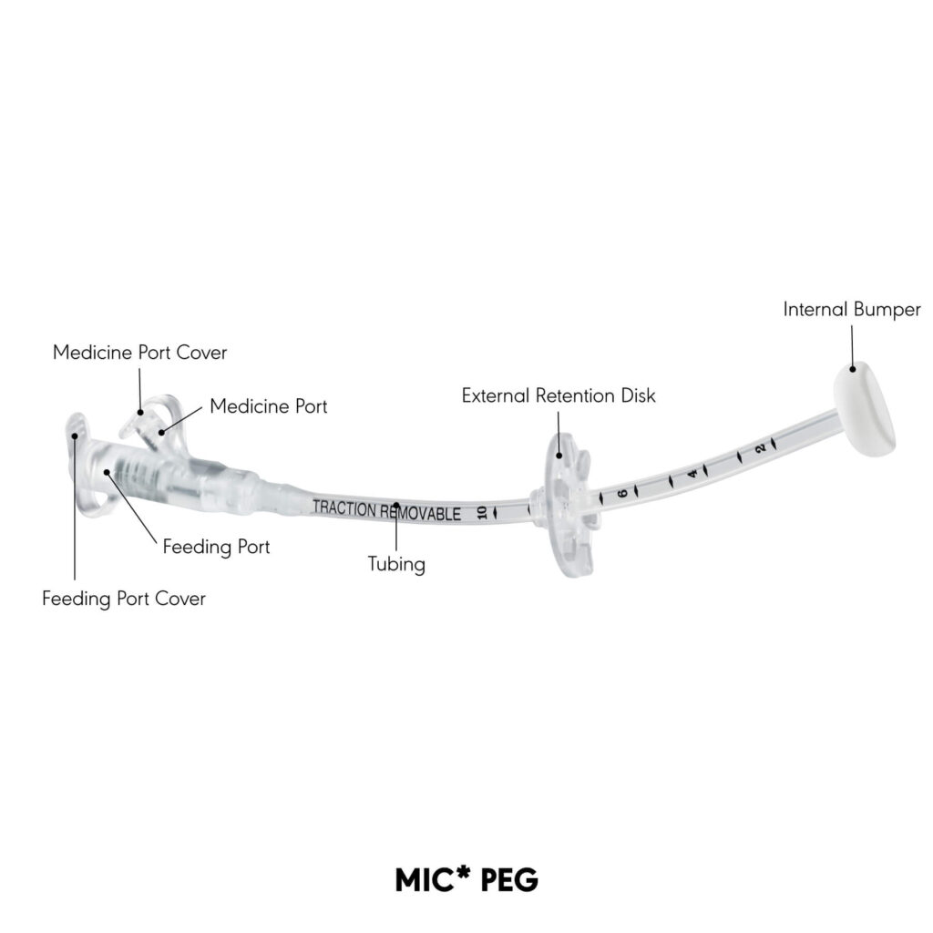 Percutaneous Endoscopic Gastrostomy (PEG) Tubes - TubeFed